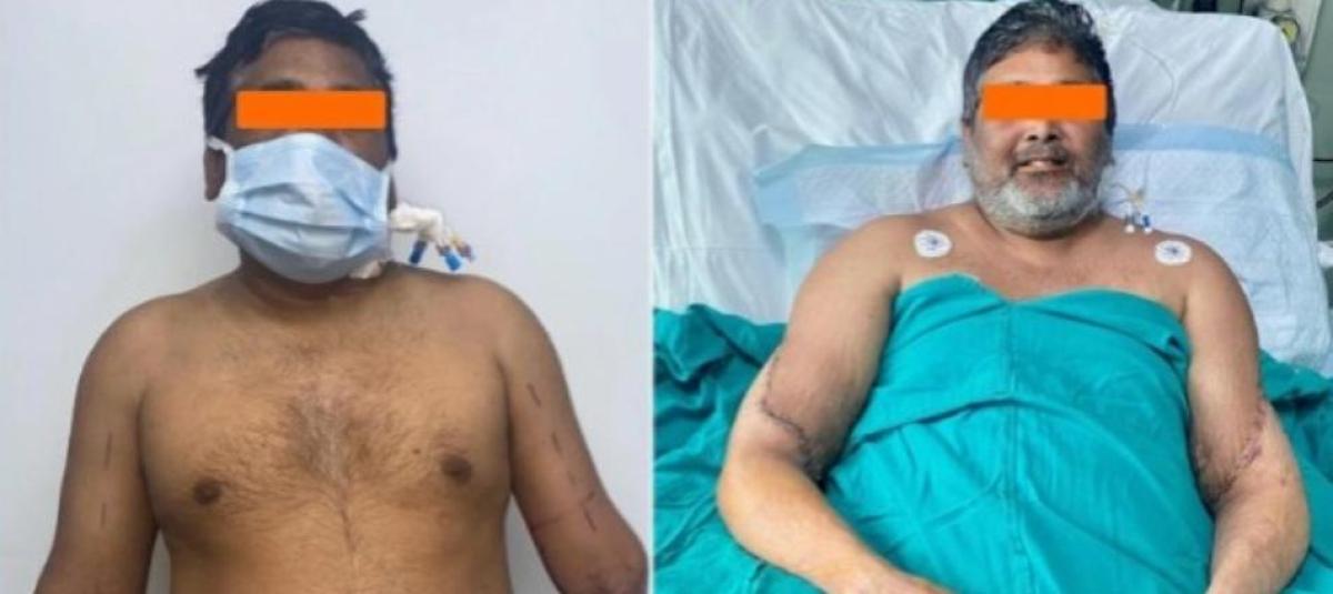 Artista perdió sus brazos en un accidente y una mujer le donó los suyos