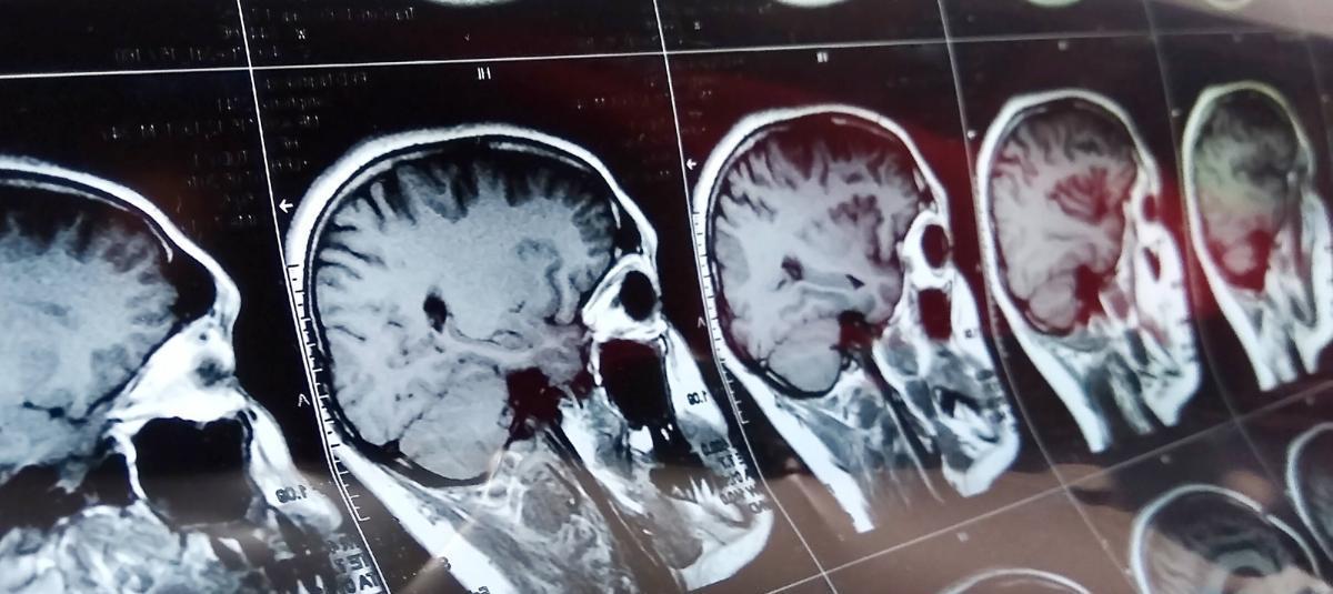 Mujer acudió al médico con un tumor tipo 3 y el doctor le recetó un día ...