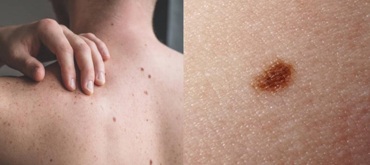 En Barranquilla alertan por altos niveles de radiación UV: jornada gratuita de chequeo de ...