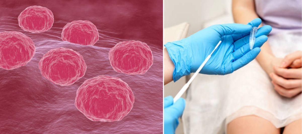 Clamidia, la infección de transmisión sexual que ataca sin síntomas y ...