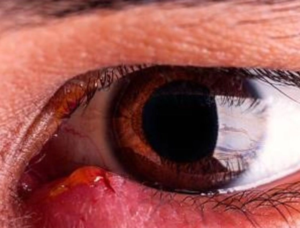 Orzuelo: qué ocurre en los ojos cuando aparece esta inflamación en el ...