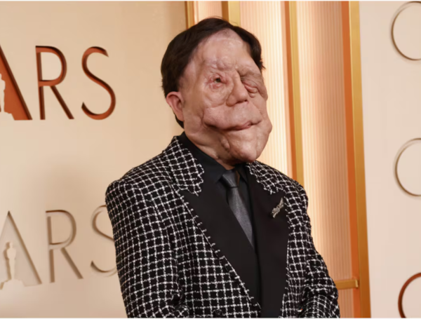 La enfermedad genética de Adam Pearson que despertó preguntas en los ...
