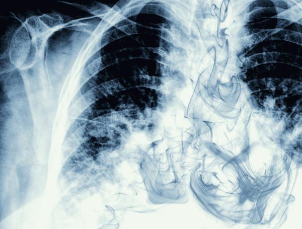 Cáncer de pulmón: ¿cómo influye el diagnóstico temprano en la salud del ...