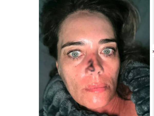 Michelle Davis: por grano en la nariz descubre que tiene cáncer