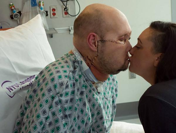 El impresionante progreso de la primera persona del mundo que recibió un trasplante de ojo humano