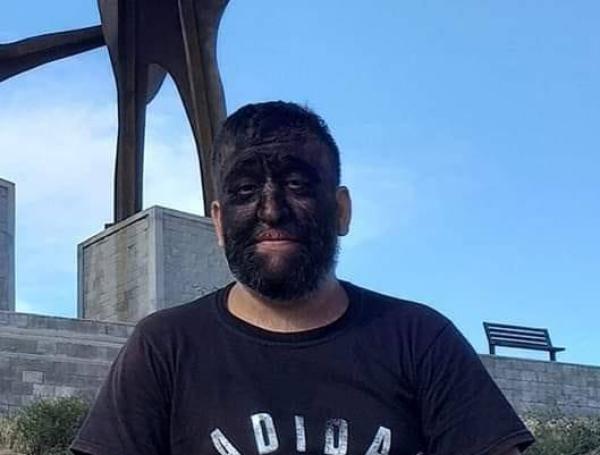 Así está en 2024 'el hombre lobo', quien ganó un Récord Guinness