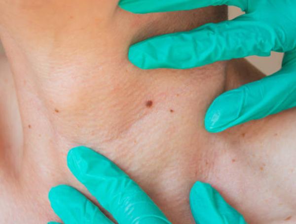 En Barranquilla alertan por altos niveles de radiación UV: jornada gratuita de chequeo de ...