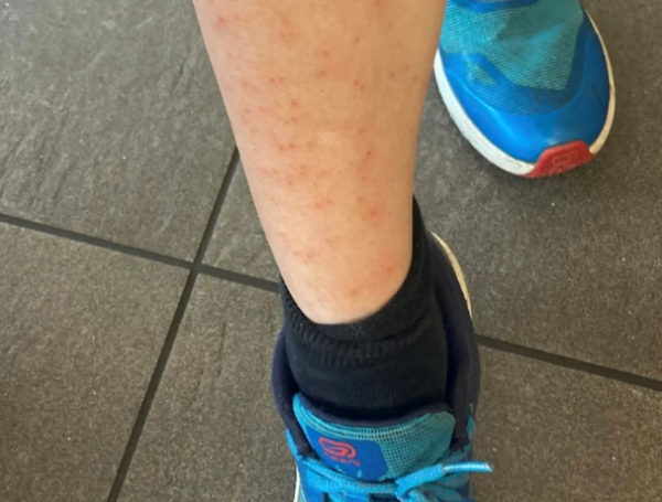 Mujer alérgica al agua cuenta su dolorosa experiencia cuando llueve ...