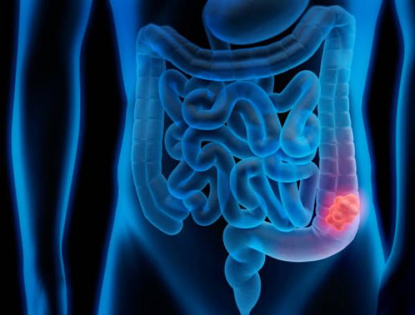Síntomas de cáncer de colon y colon irritable: ¿cómo diferenciarlos ...