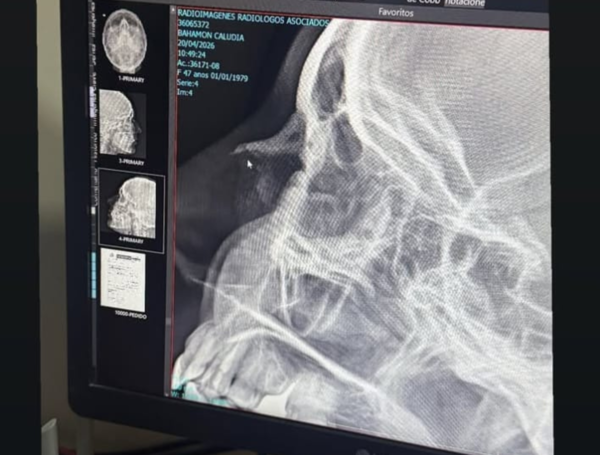 Claudia Bahamón sufrió una fractura en la nariz durante las grabaciones ...
