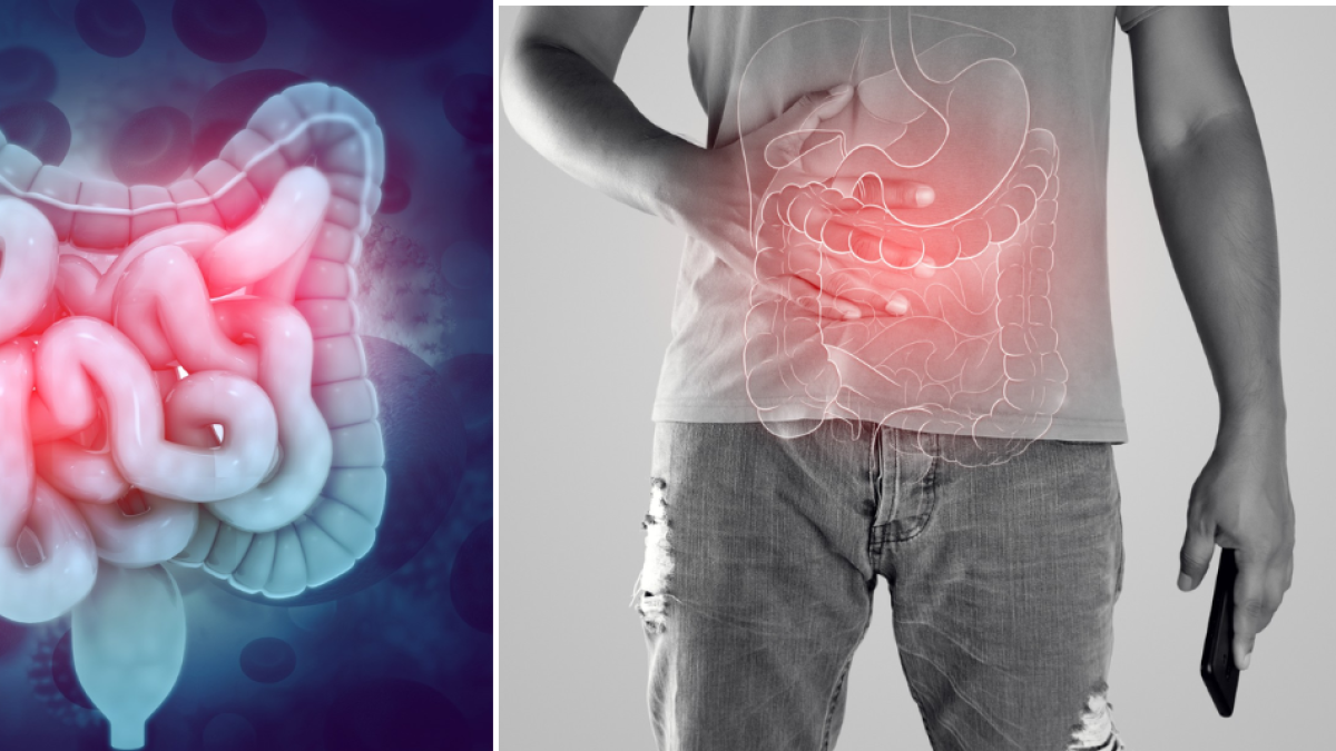 ¿Cómo saber si tiene el colon obstruido? Algunos síntomas que podrían ...