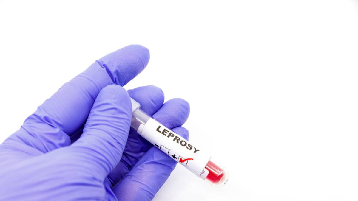 Lepra, un antiguo estigma que sigue vigente