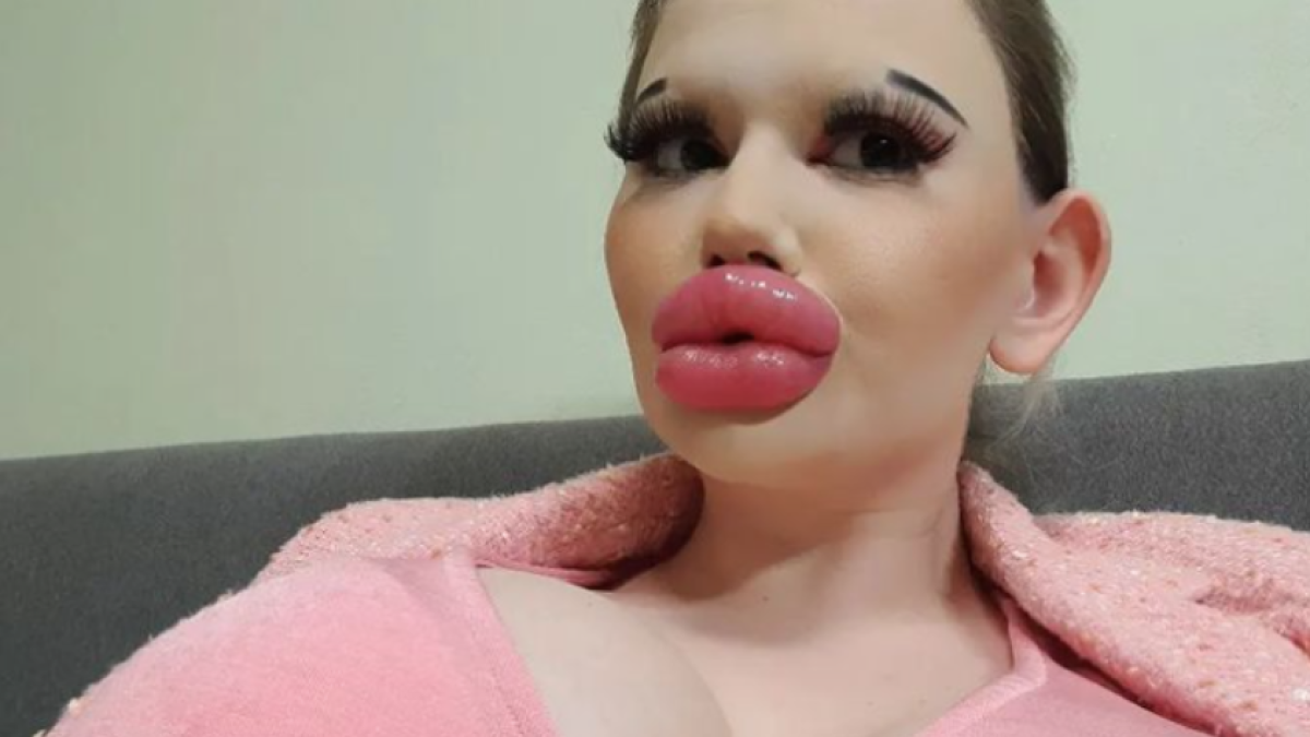Mujer en Bulgaria se puso 30 inyecciones en los labios ser Barbie humana
