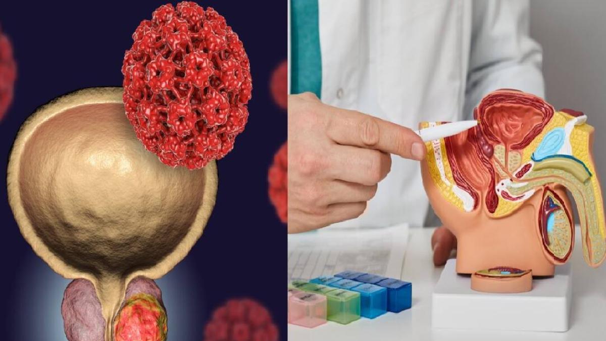 Cáncer de próstata: cinco hábitos saludables para prevenir su aparición