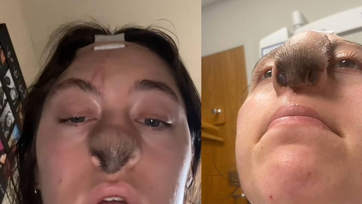 Trinity Rowles:sufrió lesión en la cara y ahora tiene pelo en toda la nariz