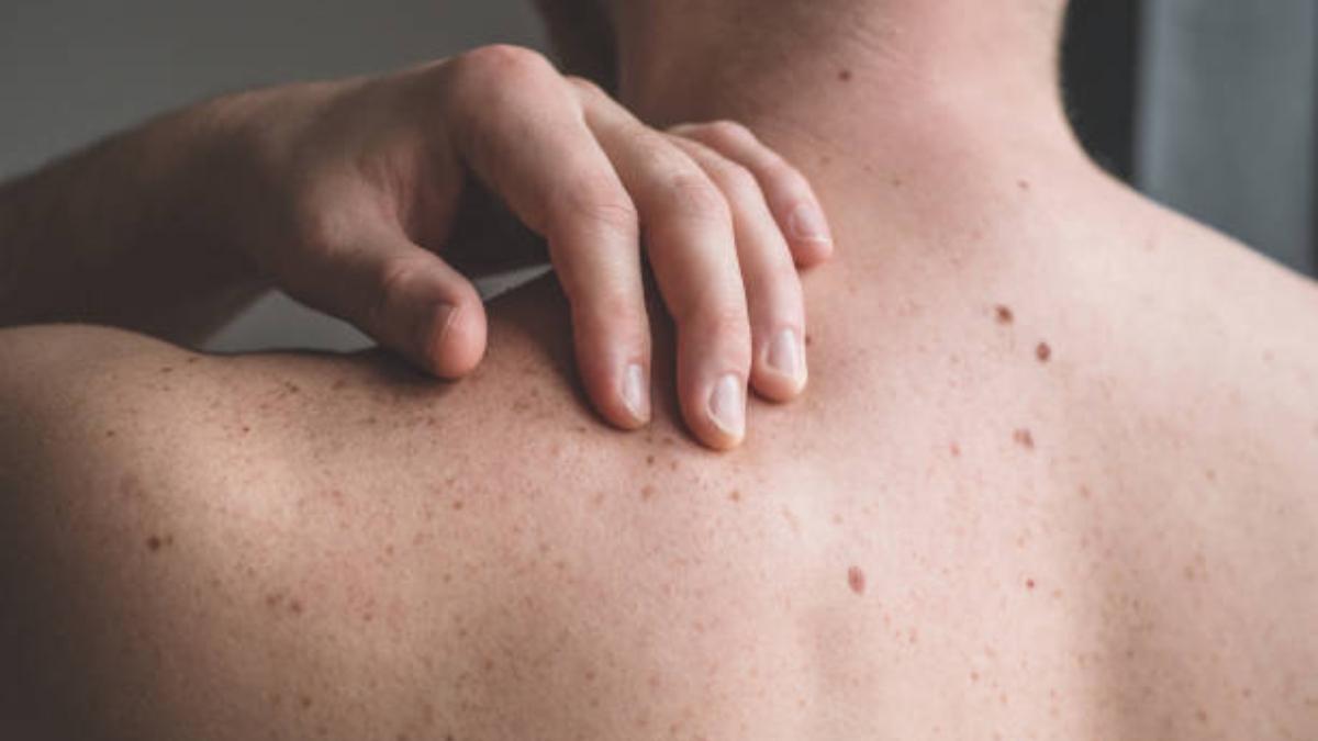 Si toma estos medicamentos, cuidado, podrían exponerlo al cáncer de piel