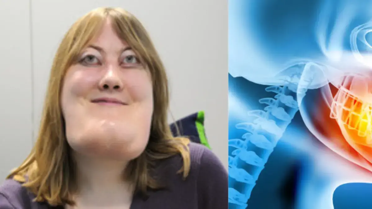 El caso médico de Victoria Wright: notó que su rostro comenzó a cambiar, su mandíbula se agrandó ...