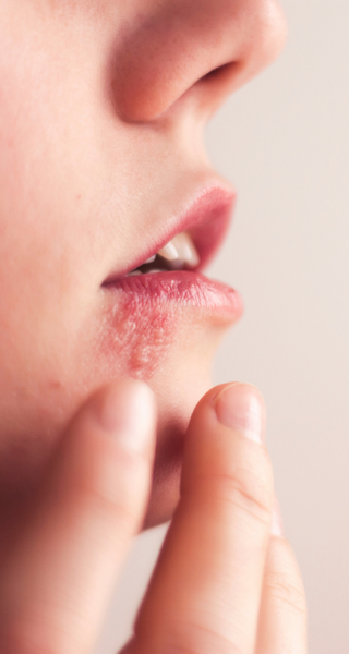 Herpes labial en niños: ¿cuáles son sus causas y tratamiento?