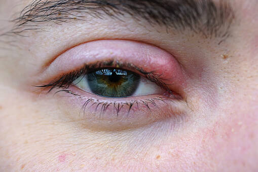 Orzuelo: qué ocurre en los ojos cuando aparece esta inflamación en el ...