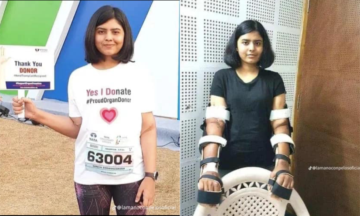 Shreya Siddanagowder: la joven que recibió trasplante de manos de un hombre