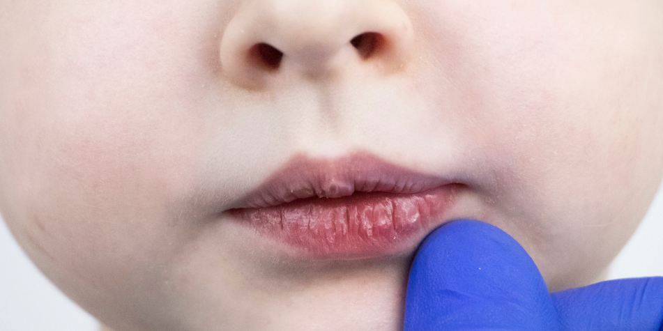 Labios resecos: causas, riesgos y los productos recomendados por ...