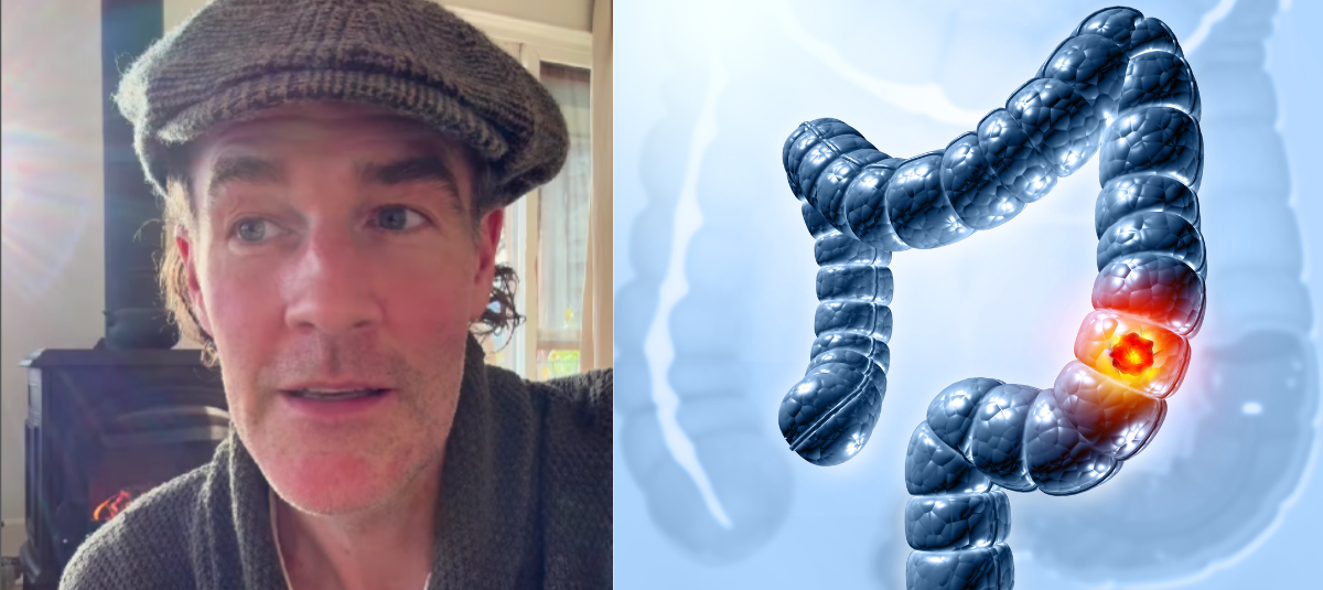 Estos son los síntomas de cáncer de colon, la enfermedad por la que ...