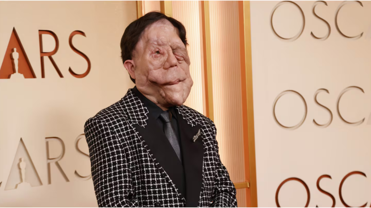 La enfermedad genética de Adam Pearson que despertó preguntas en los ...